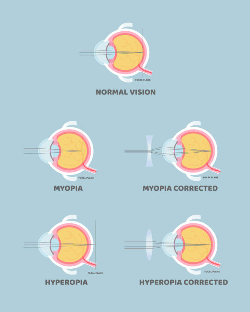 Myopia and Nearsightedness: Are They Different? - The Laser Center of Coral Gables